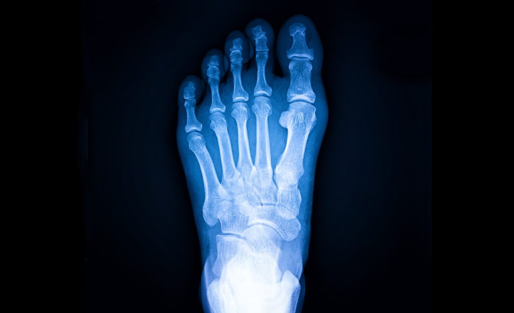 Cartiva Toe Implant Recall Issued by Stryker: What You Need to Know